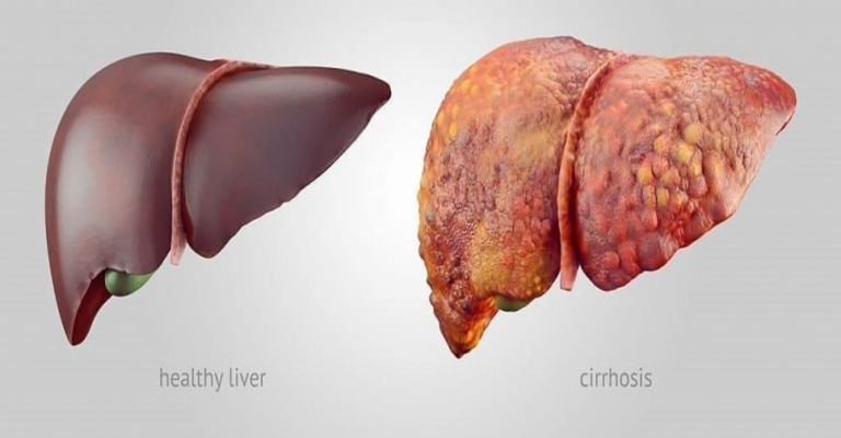 HEPATOCELLULAR CARCINOMA (HCC) / LIVER CANCER – WHAT YOU SHOULD KNOW - EIVH